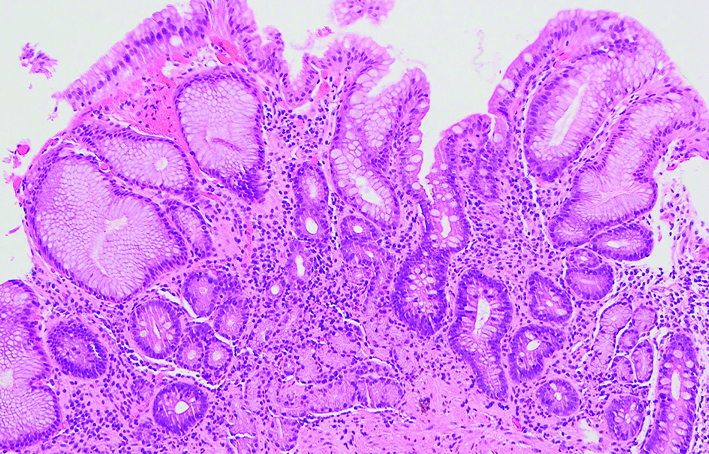 Gastritis | Sonic Bookings