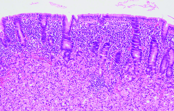 Atrophic Gastritis Histology Atrophic Gastritis: Background,