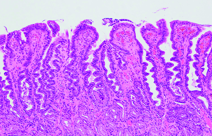 Gastritis | Sonic Bookings