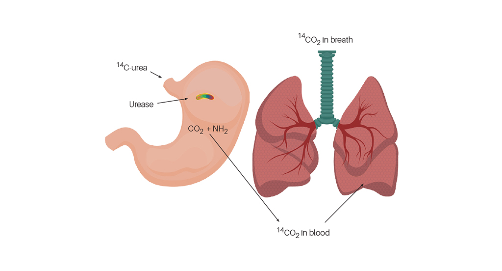 C14-urea breath test | Sonic Bookings